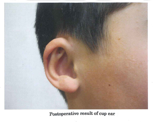 Cup ear｜Nagata Microtia and Reconstructive Plastic Surgery Clinic
