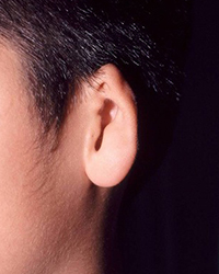 Concha Type｜Nagata Microtia and Reconstructive Plastic Surgery Clinic